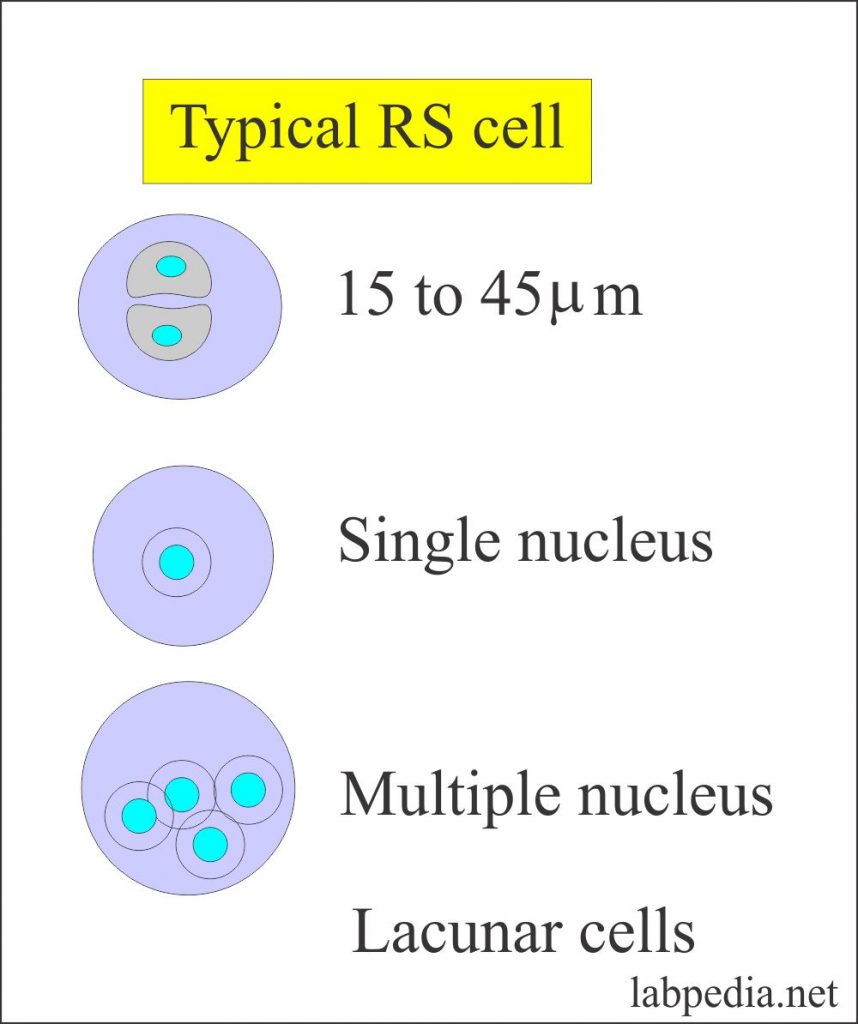 Hodgkin's Lymphoma / Disease - Labpedia.net