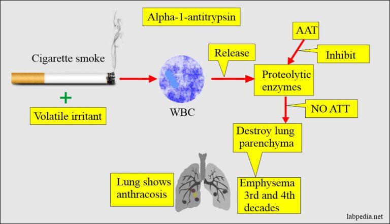 alpha-1-antitrypsin Deficiency, (α1-antitrypsin or AAT Deficiency ...