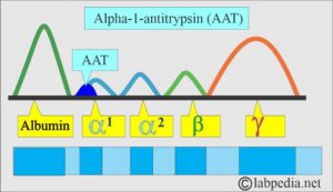 Understanding Alpha-1-Antitrypsin Deficiency and Its Impact