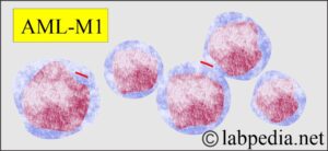 Understanding Acute Leukemias: Diagnosis and Types