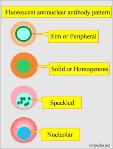 Anti-DNA, (anti-double-stranded DNA antibodies, Anti-ds-DNA Ab) and ...
