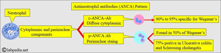 Antineutrophil cytoplasmic antibody (ANCA), Wegener's Granulomatosis ...