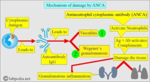 Antineutrophil cytoplasmic antibody (ANCA), Wegener's Granulomatosis ...