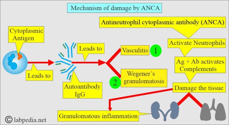 Antineutrophil cytoplasmic antibody (ANCA), Wegener's Granulomatosis ...