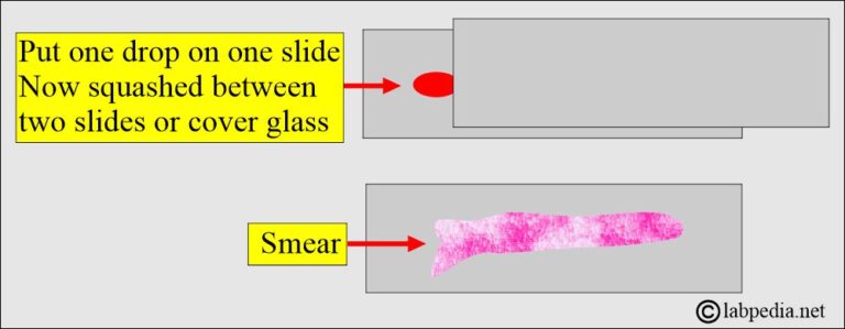 Bone Marrow Aspiration and Trephine Biopsy, Myeloerthyropoeisis Part 1 ...