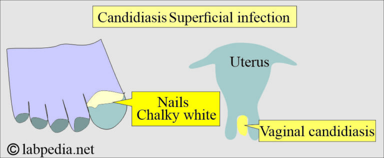 Candidiasis, Candida albicans and Diagnosis - Labpedia.net