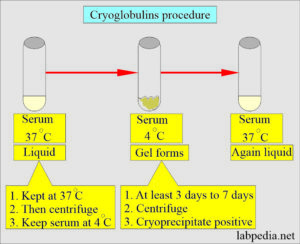 Cryoglobulins classfication and diagnosis