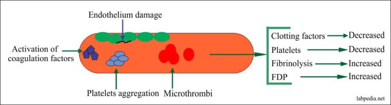 D-Dimer test, Fragment D-dimer, Diagnosis of Disseminated Intravascular ...