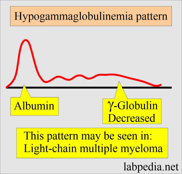 Immunoglobulin Electrophoresis, Immunoglobulins Pattern in Various ...