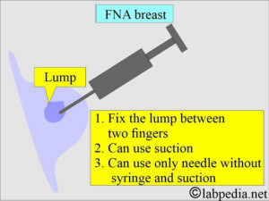 Fine Needle Aspiration Cytology (FNAC), Fine Needle Aspiration Biopsy ...