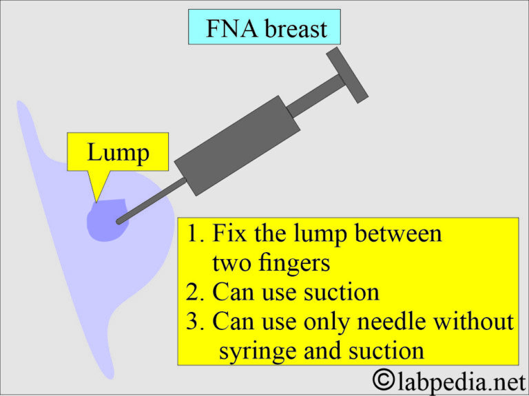 Fine Needle Aspiration Cytology (FNAC), Fine Needle Aspiration Biopsy ...