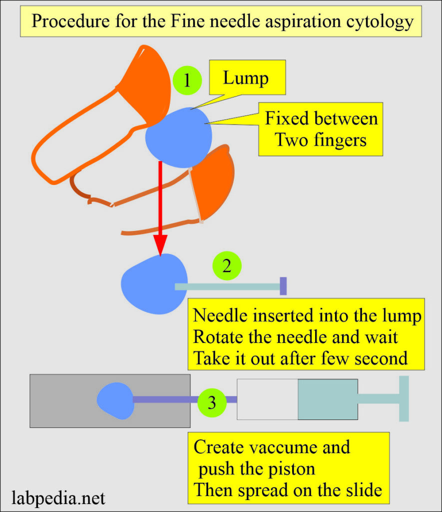 Fine Needle Aspiration Cytology (FNAC), Fine Needle Aspiration Biopsy (FNAB)