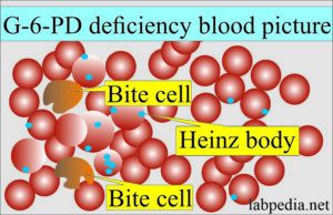 Glucose-6-phosphate Dehydrogenase deficiency (G6PD deficiency ...
