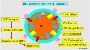 Glucose-6-phosphate Dehydrogenase deficiency (G6PD deficiency ...