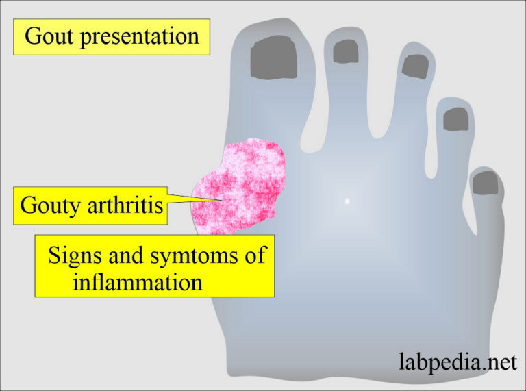 Uric acid Quantitative (24-Hours Urine), Uricosuria - Labpedia.net