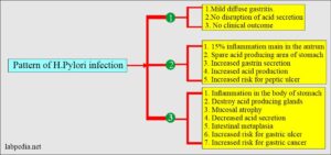 Urea Breath Test for H. Pylori (Helicobacter Pylori) - Labpedia.net