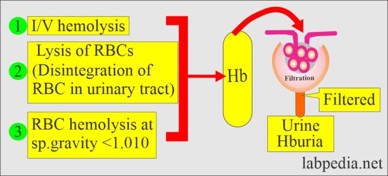 Urine Hemoglobin (Hemoglobinuria) - Labpedia.net