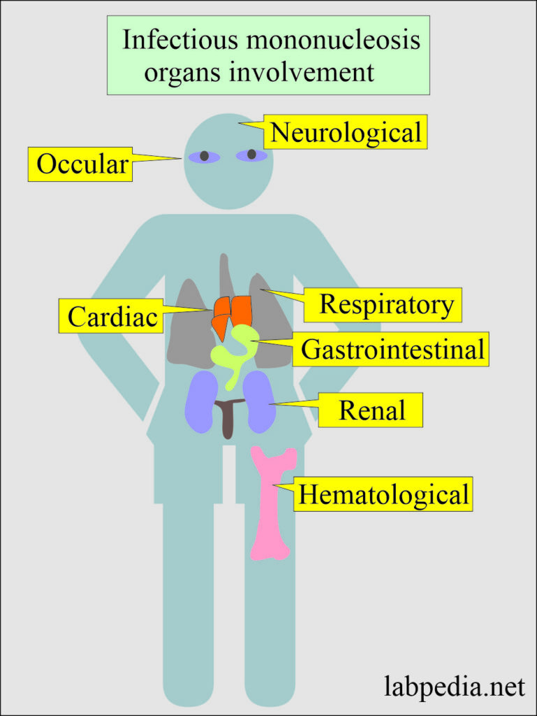 Epstein-Barr virus (EBV) and Infectious mononucleosis