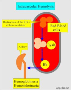 Anemia:- Part 8 - Hemolytic Anemias Classification, Lab Diagnosis ...