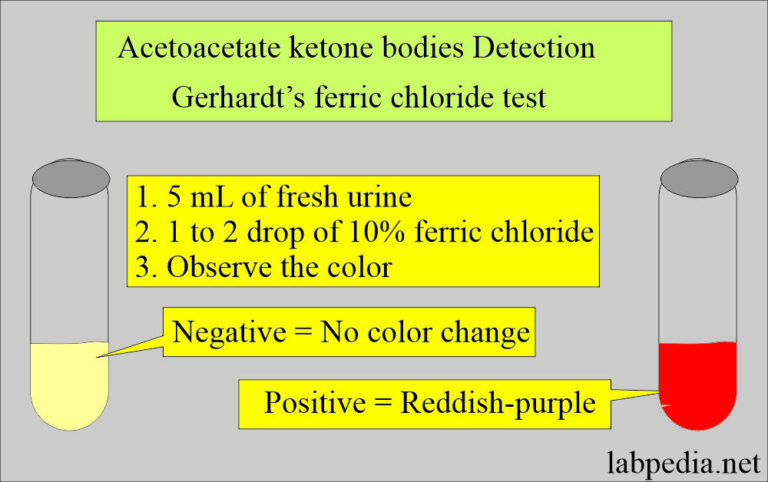 Urine for ketones, and Ketone Bodies (Ketonuria) - Labpedia.net