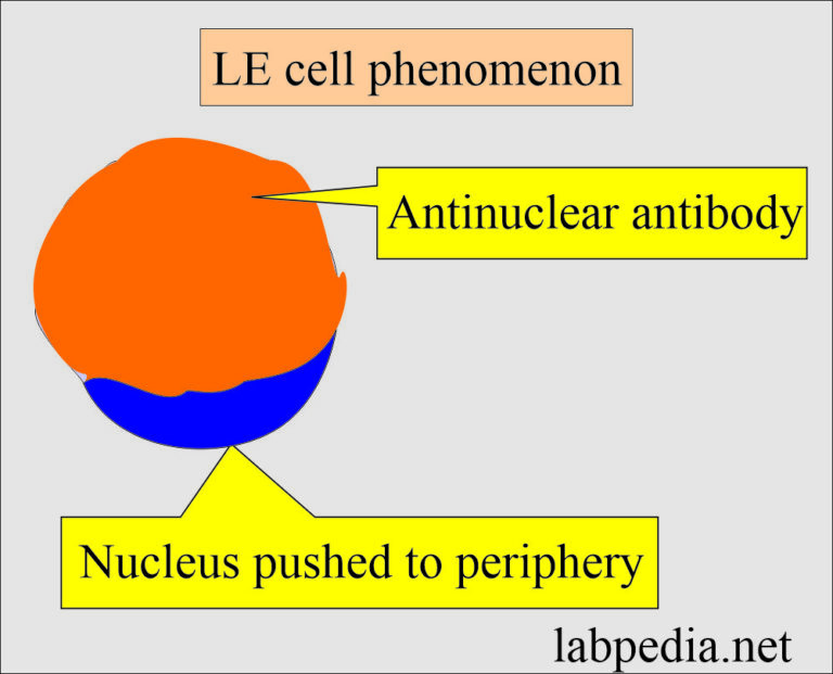 LE cell phenomenon (Lupus erythematosus cell) - Labpedia.net