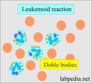 Leukemoid Reaction and Diagnosis (D/D from Chronic Myelocytic leukemia) - Labpedia.net