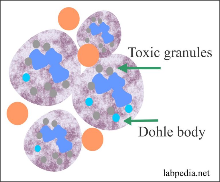 Leukemoid Reaction and Diagnosis (D/D from Chronic Myelocytic leukemia) - Labpedia.net