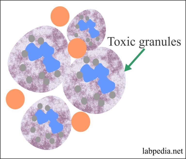 Leukemoid Reaction and Diagnosis (D/D from Chronic Myelocytic leukemia ...