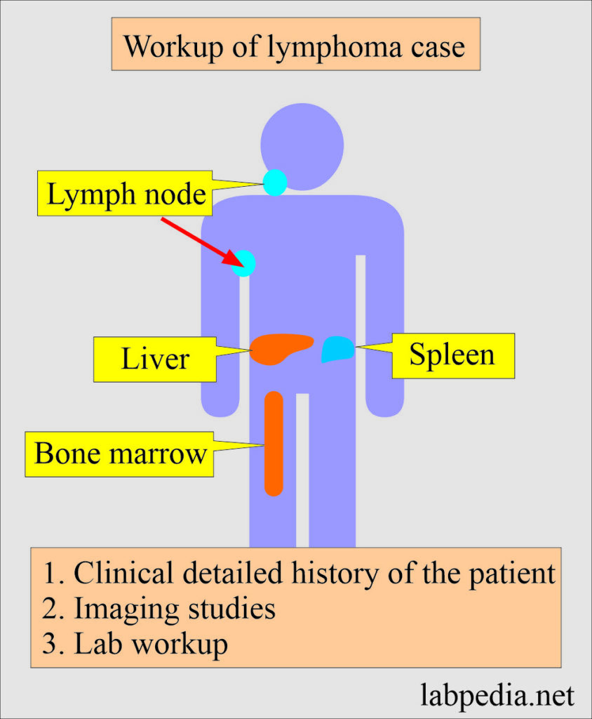 Workup of Lymphoma case - Labpedia.net