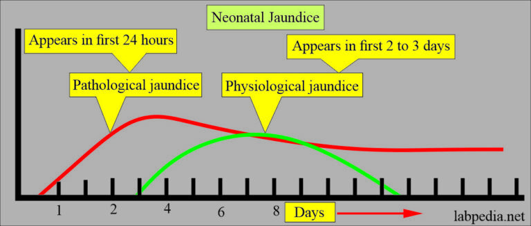 neonatal jaundice, classification and diagnosis