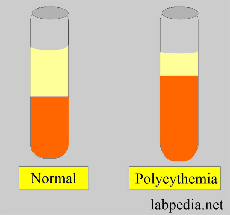 Polycythemia (Erythrocytosis), Polycythemia Rubra Vera, and Secondary ...