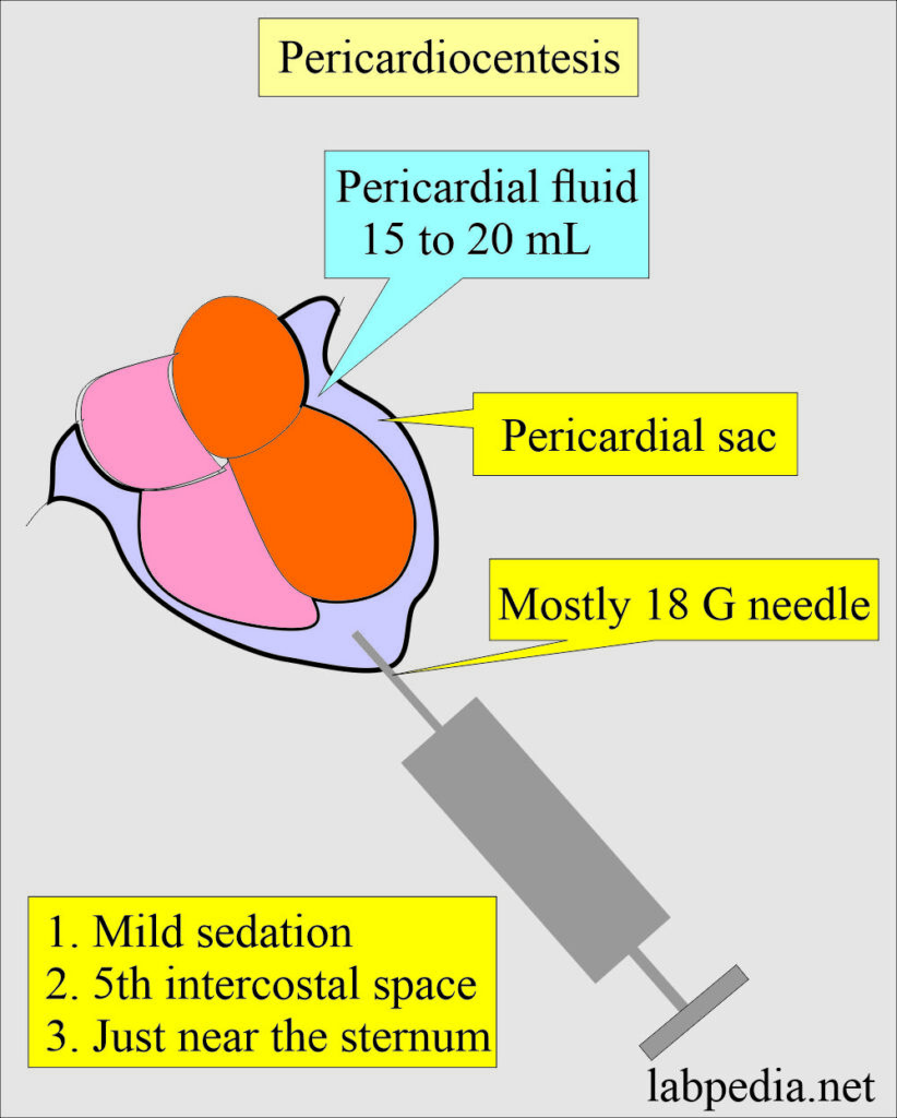 Fluid Analysis:- Part 7 - Pericardial Fluid Analysis, Pericardiocentesis