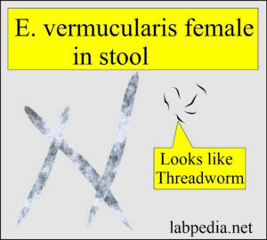 Enterobius Vermicularis (Pinworms), Diagnosis and Treatment