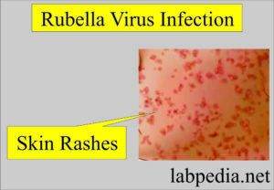 TORCH Profile:- Part 1 - Rubella virus (German Measles) - Labpedia.net