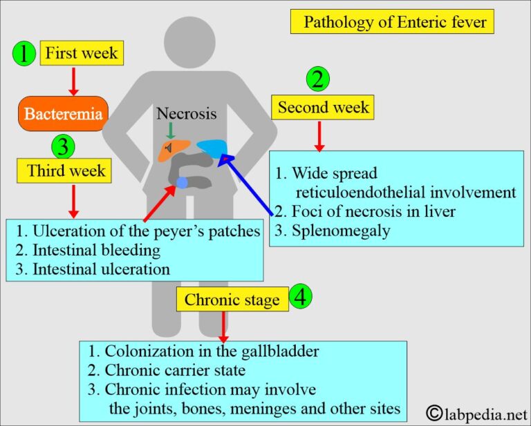 Typhoid Fever, Enteric Fever (Salmonella typhi)