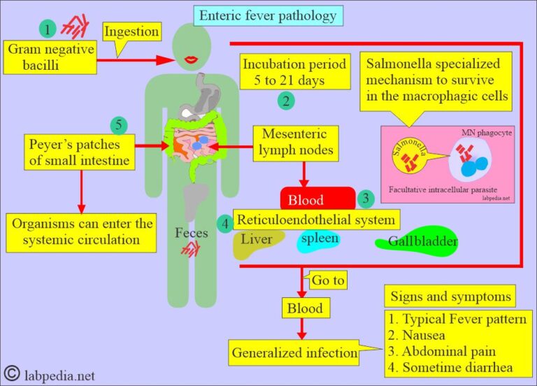 Typhoid Fever, Enteric Fever (Salmonella typhi)