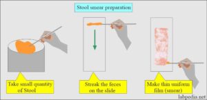 Stool Examination:- Part 1 - Stool Examination and Interpretations ...