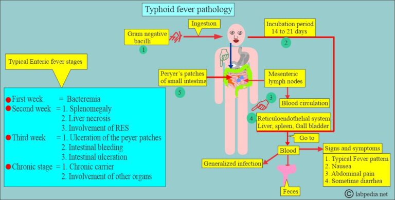 Typhoid Fever, Enteric Fever (Salmonella typhi)