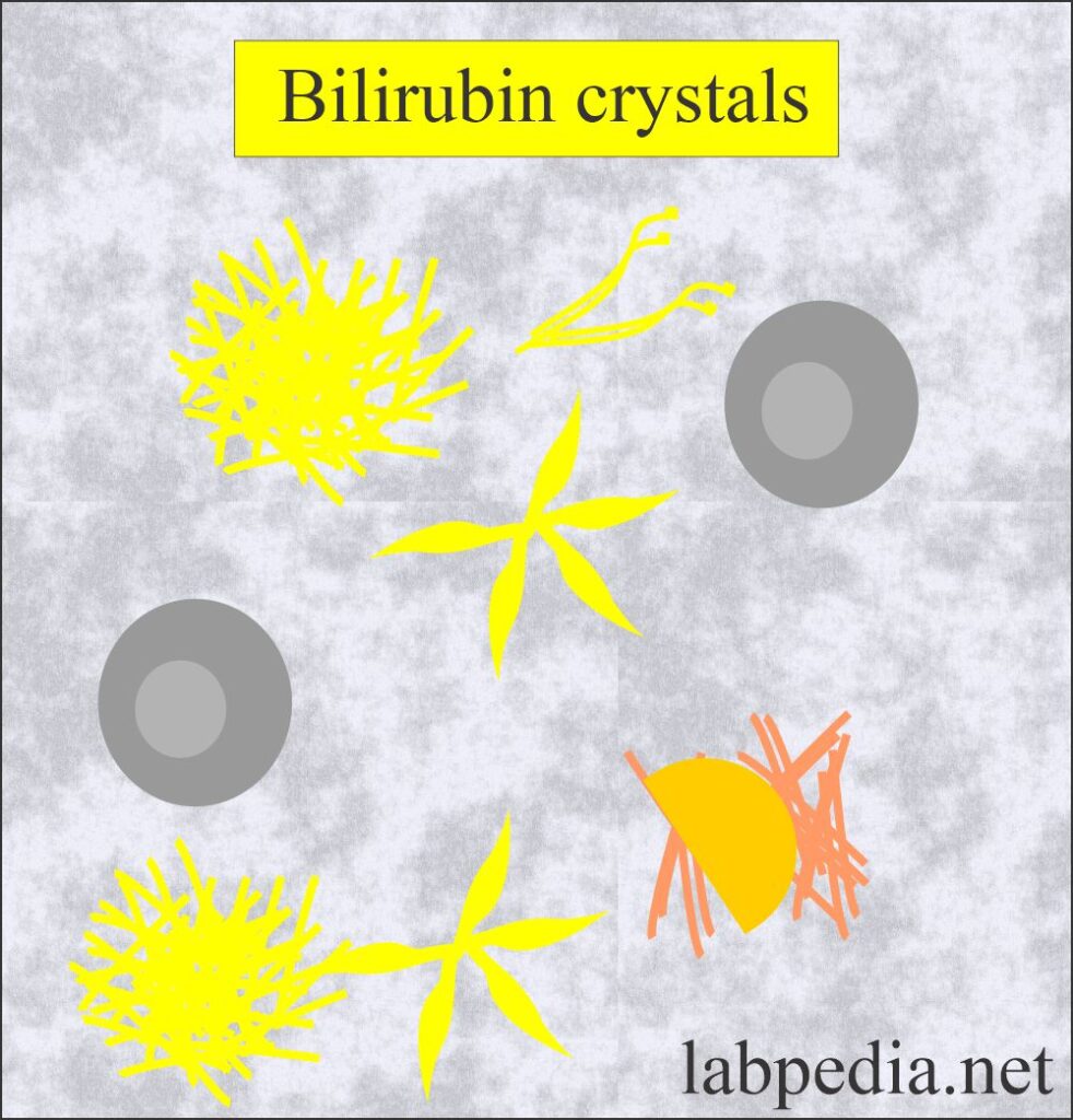Urine Crystals (Crystalluria) - Labpedia.net