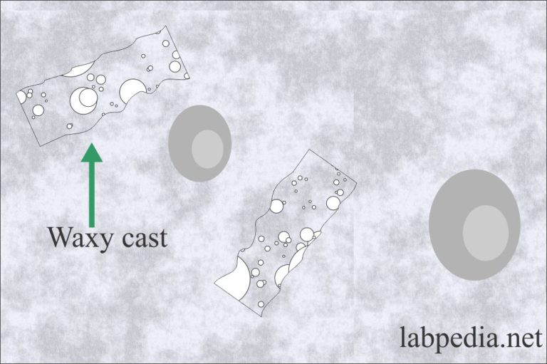 Urine Analysis:- Part 2 - Microscopic Examination and Interpretations ...