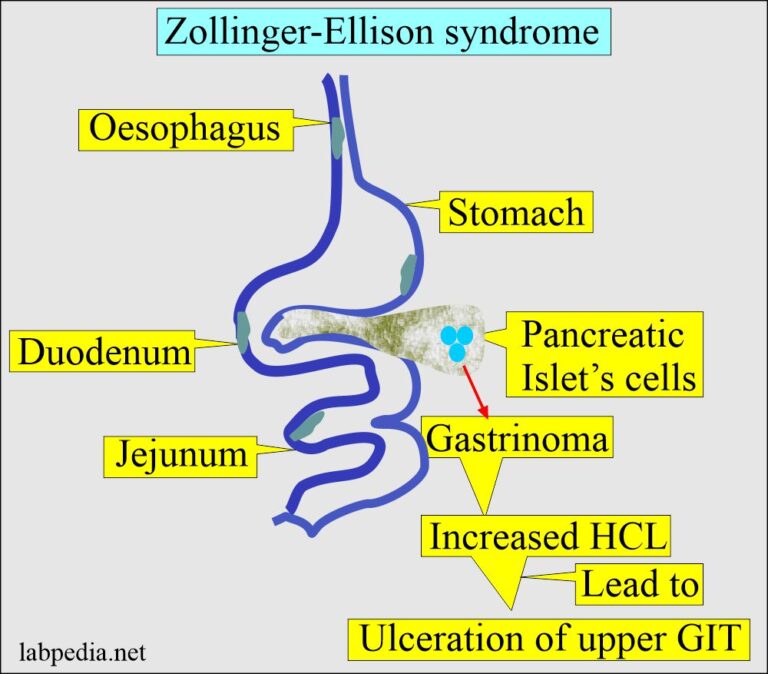 Zollinger-Ellison Syndrome, gastrinoma