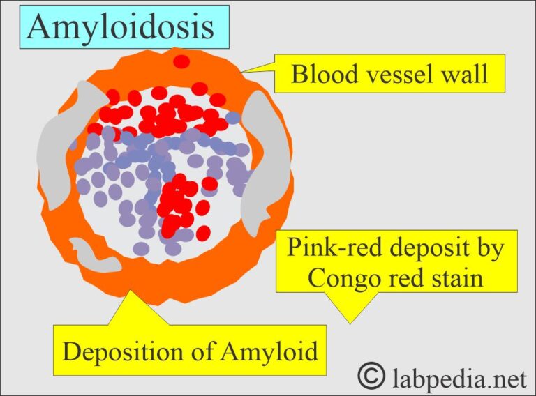 Amyloidosis, Samples, and Diagnosis - Labpedia.net