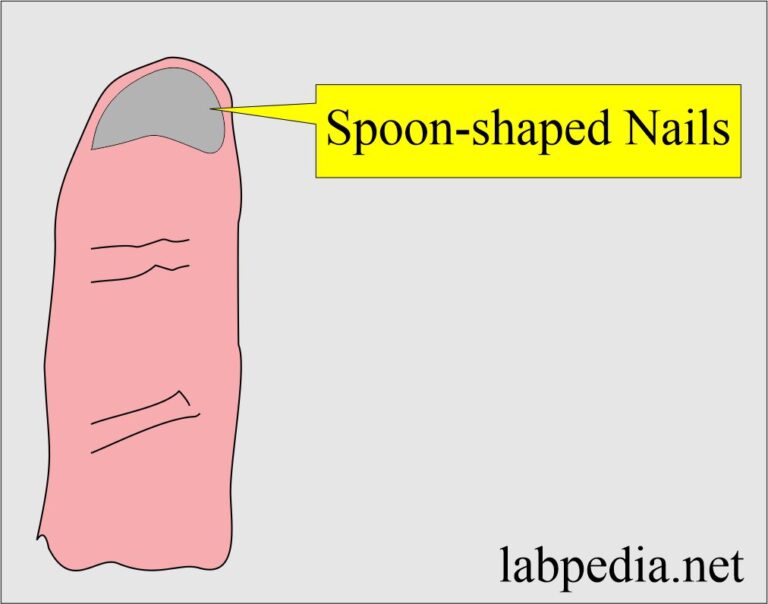 Anemia classification, diagnosis, and routine workup