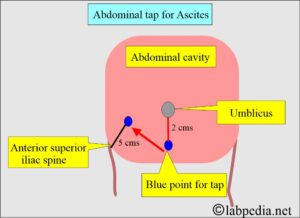 Fluid Analysis:- Part 4 - Ascitic fluid Abdominal Paracentesis ...