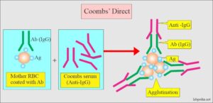 Coomb's test direct for the detection of antibody