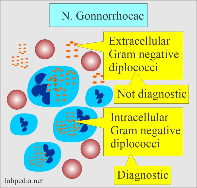 Gonorrhea, Diagnosis of Neisseria Gonorrhoeae - Labpedia.net