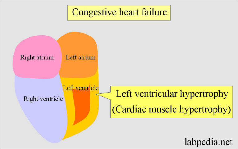 Congestive Heart Failure, Lab Work up - Labpedia.net