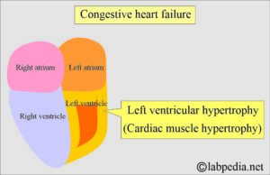 Congestive Heart Failure, Lab Work up - Labpedia.net