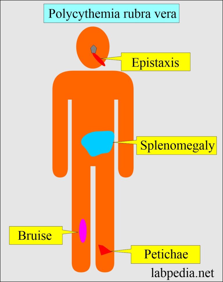 Polycythemia (Erythrocytosis), Polycythemia Rubra Vera, and Secondary ...