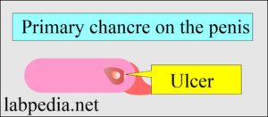 Syphilis:- Part 1- Syphilis Presentation (Treponema Pallidum ...